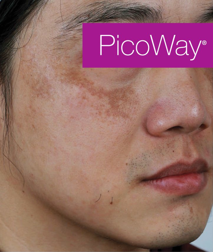 Picoway – BEAMED