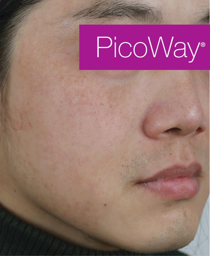 Picoway – BEAMED